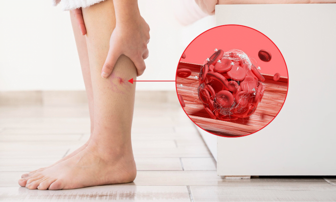 Angiólogo especialista en várices Querétaro - Dr Carlos Salazar