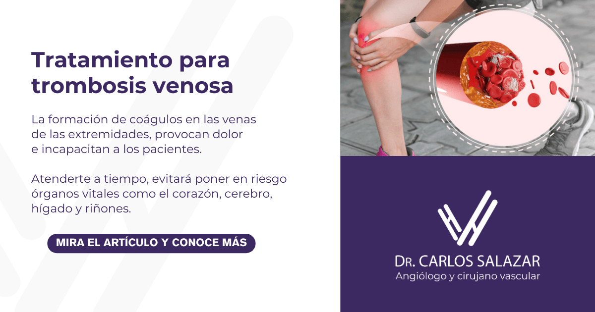 Tratamiento de trombosis venosa Querétaro - Dr. Carlos Salazar
