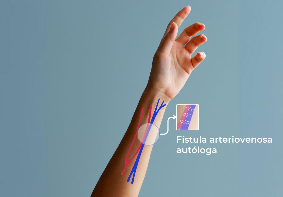 Fistula para hemodiálisis Querétaro - Dr. Carlos Salazar